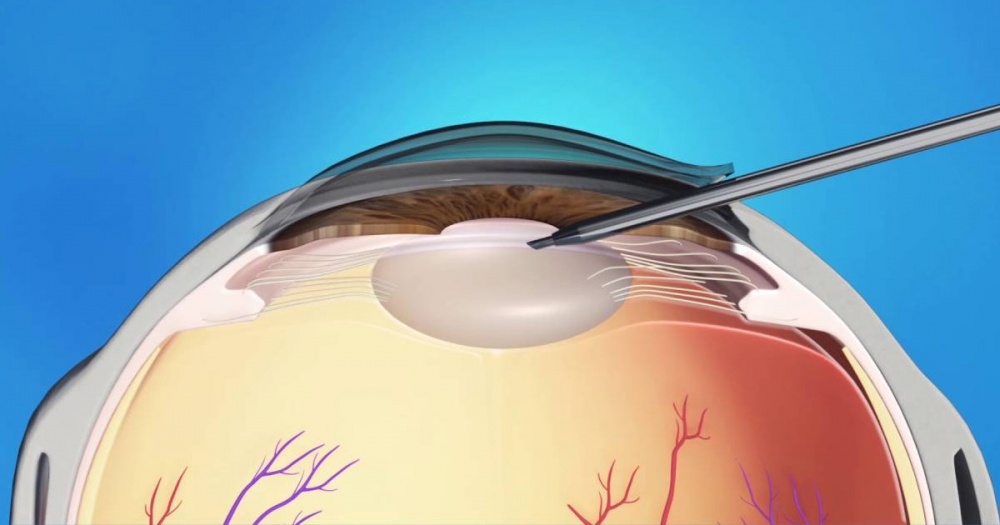 Phẫu thuật cườm khô PHACO | Bệnh viện mắt Việt