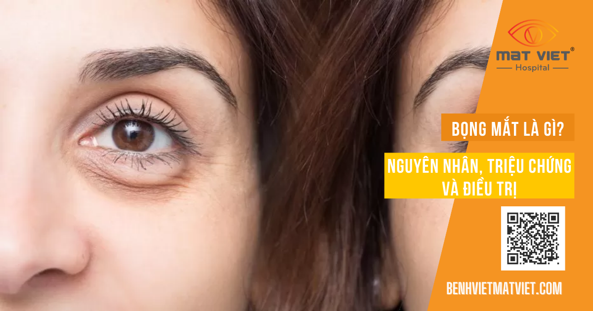 Bọng mắt là gì? Triệu chứng, nguyên nhân và điều trị