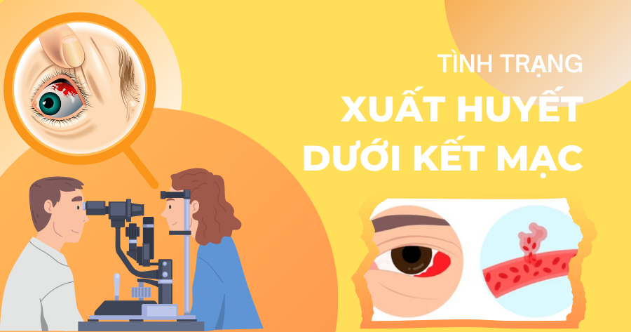 XUẤT HUYẾT MẮT - XUẤT HUYẾT DƯỚI KẾT MẠC | Bệnh viện mắt VIỆT