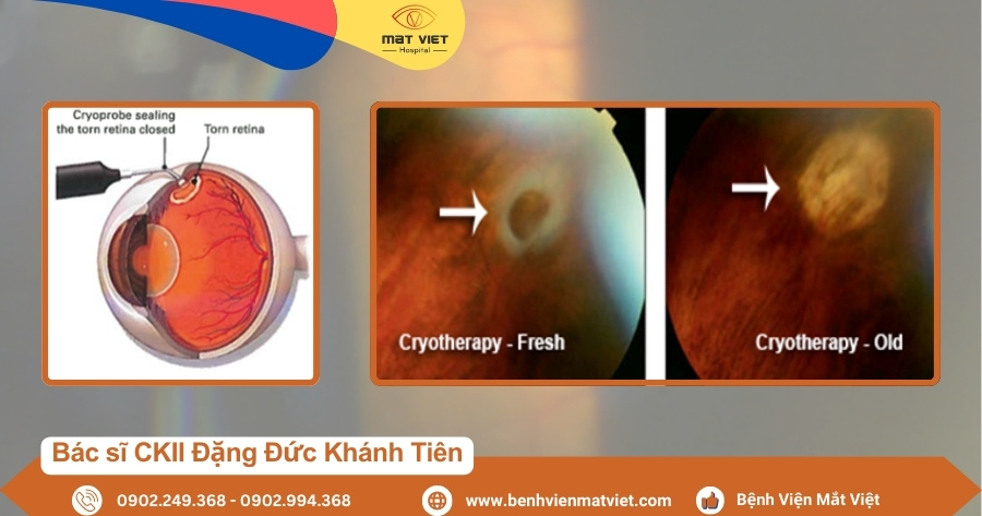 Lỗ rách võng mạc - Rách võng mạc có nguy hiểm không | Bệnh viện mắt VIỆT