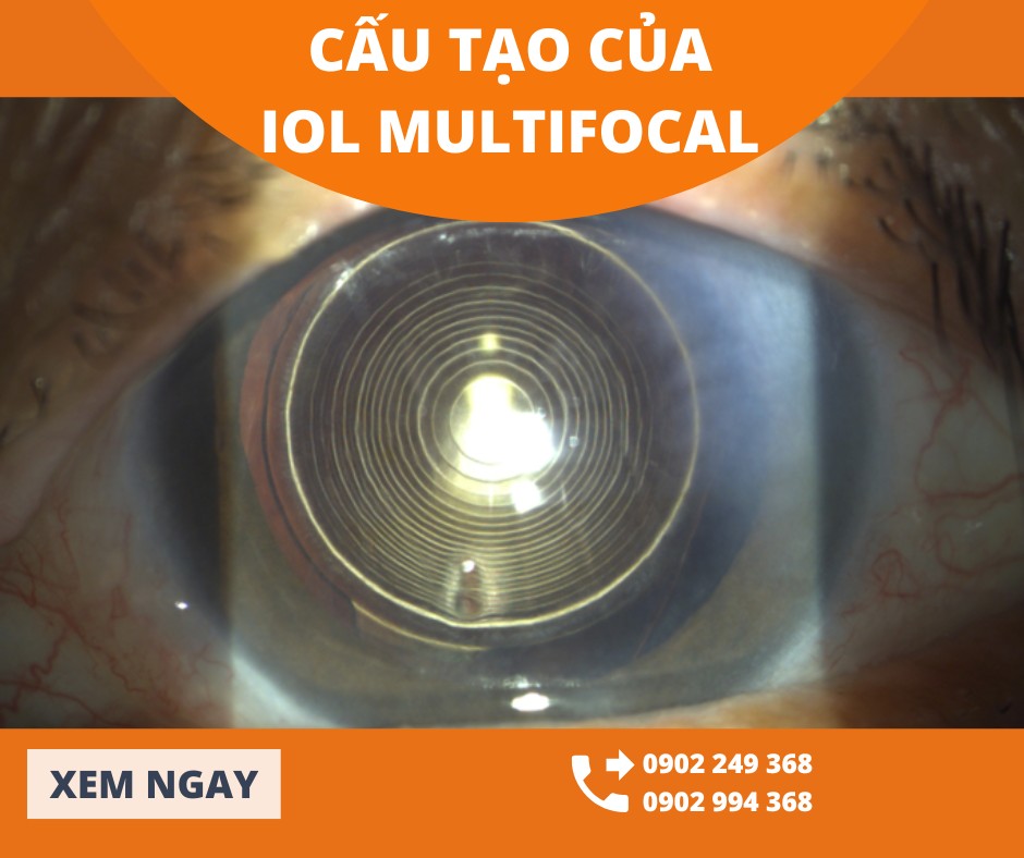 Cấu tạo của IOL Multifocal về mặt vật lý và kỹ thuật | Bệnh viện mắt VIỆT